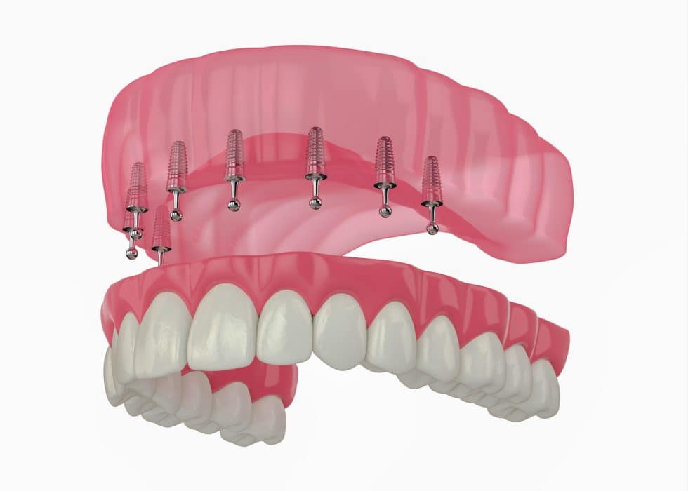 Implant Retained Dentures in Winston-Salem NC - Snap in Dentures