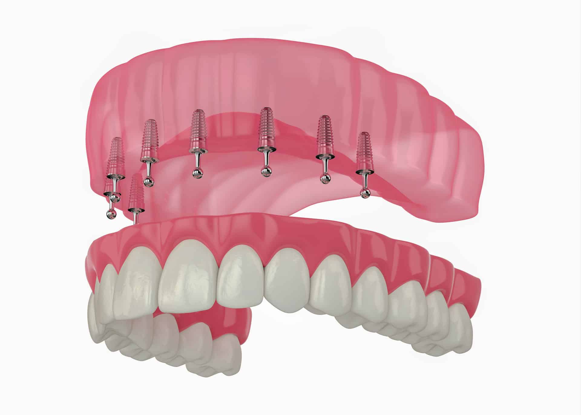 Implant Retained Dentures in Winston-Salem NC - Snap in Dentures